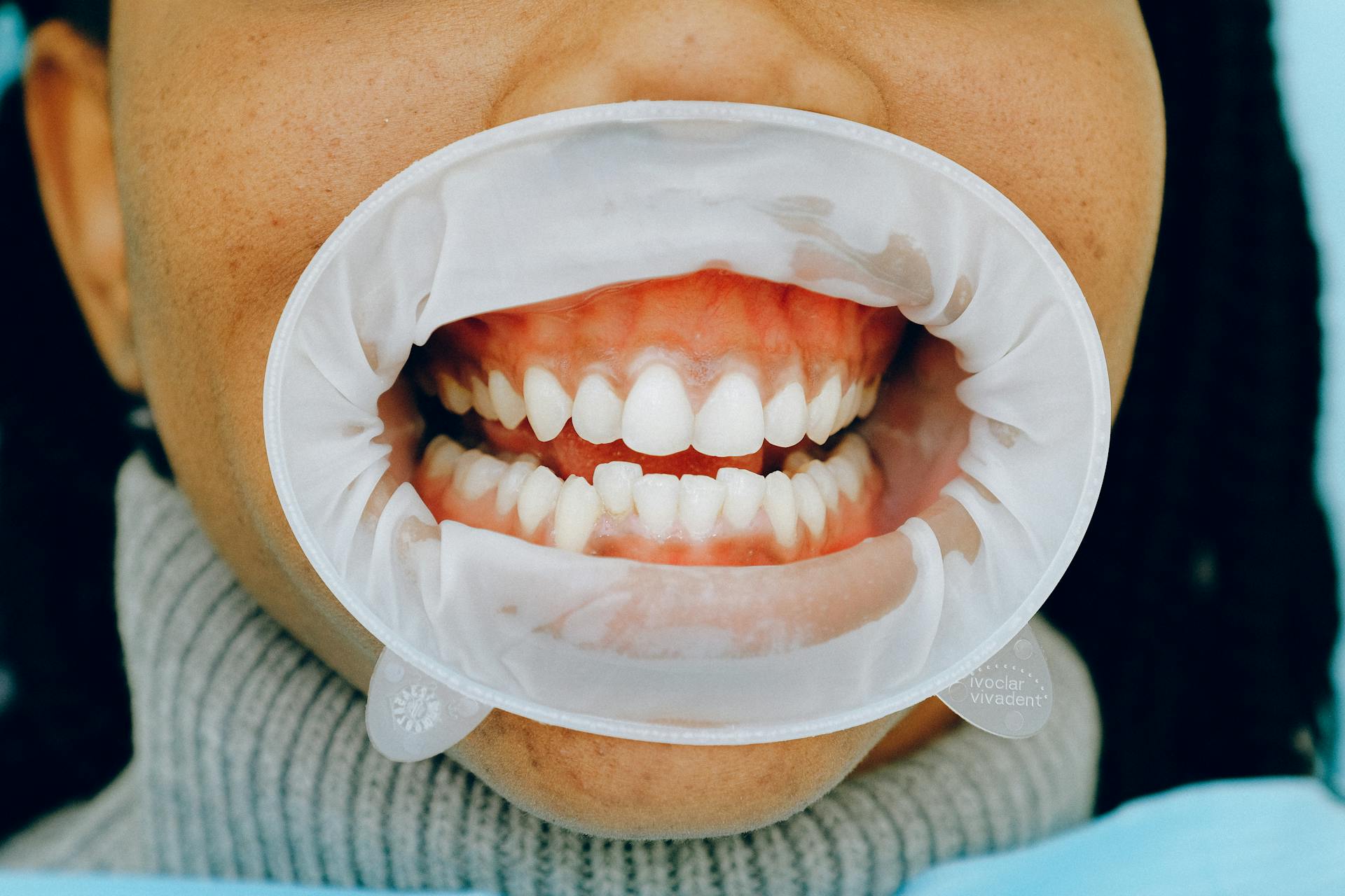 Combining invisible orthodontics with digital smile design | Doctor in ...